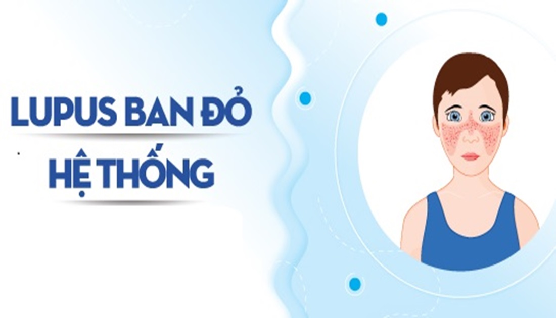 BỆNH LUPUS BAN ĐỎ - Viện Y Dược Việt
